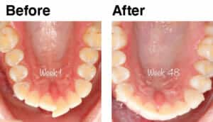 Invisalign Brisbane - invisible aligners from Wickham Terrace Dental